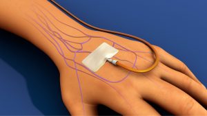 Cateter – Você conhece o que está usando? - Revista Online ABRALE