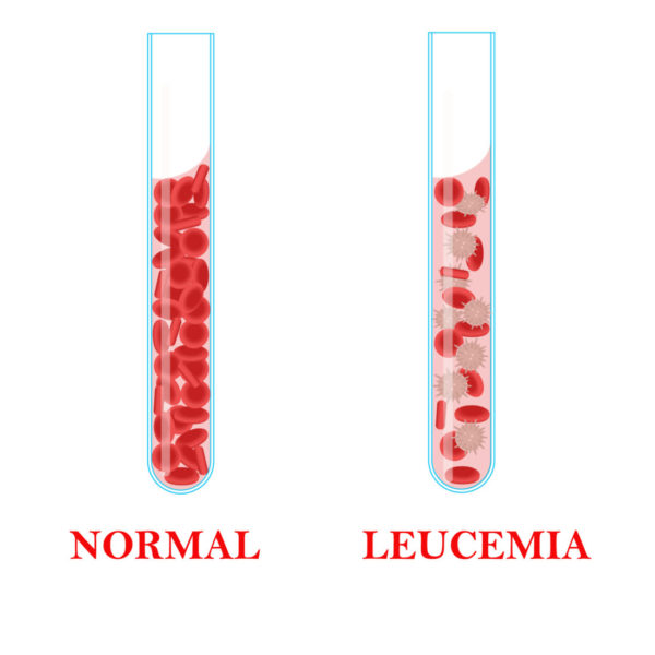 Leucemia tem cura, não é preciso ter medo - Revista Online ABRALE