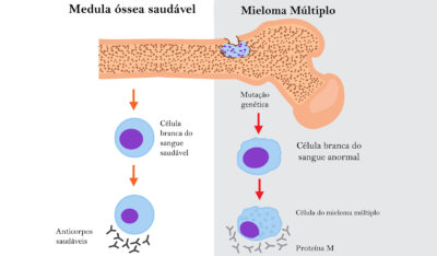 Mieloma múltiplo: o que é, sintomas e tratamentos -RevistaOnlineABRALE