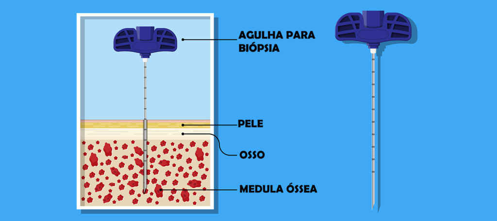 Biópsia de medula óssea: para que serve e como é feita - Revista Online ...