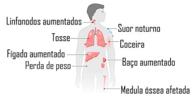 Linfoma: sintomas, diagnóstico e tratamentos - Revista Online ABRALE